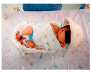 Positioning dan Nesting pada Bayi Prematur - Lanterna Indonesia